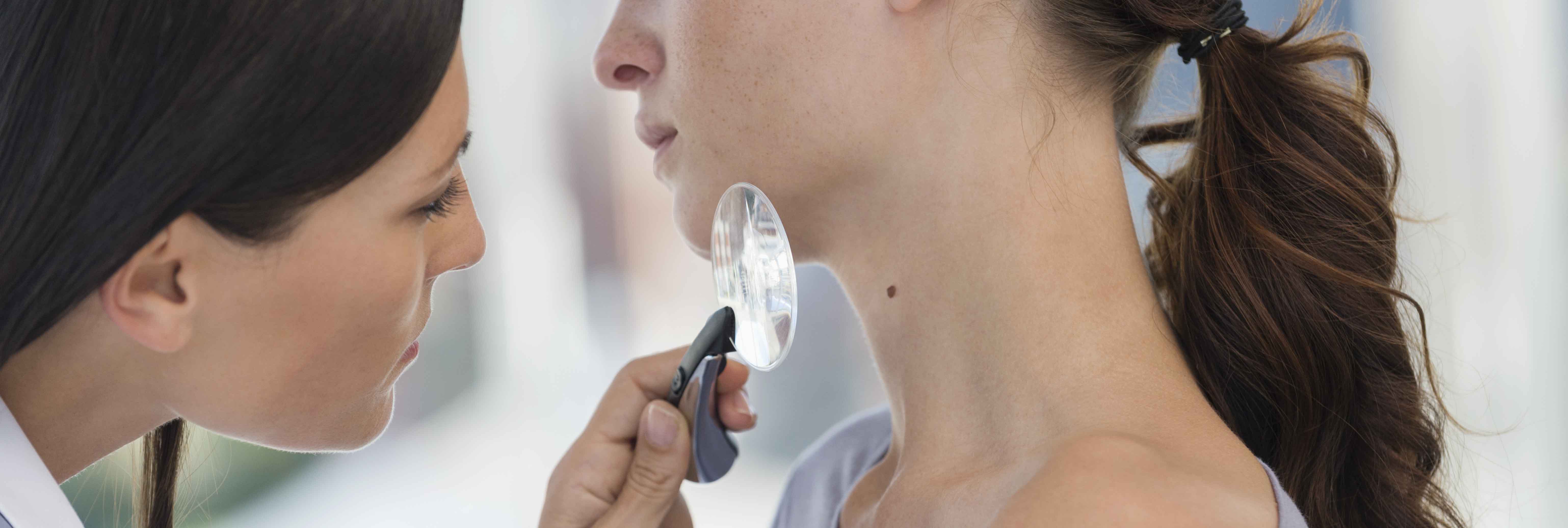 Queratosis actínica: lesión precancerosa provocada por el sol